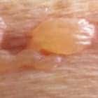 Chicago, IL - Oak/Elmwood Park - VitalSkin Dermatology