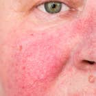 Chicago, IL - Oak/Elmwood Park - VitalSkin Dermatology