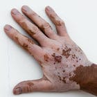 Chicago, IL - Oak/Elmwood Park - VitalSkin Dermatology