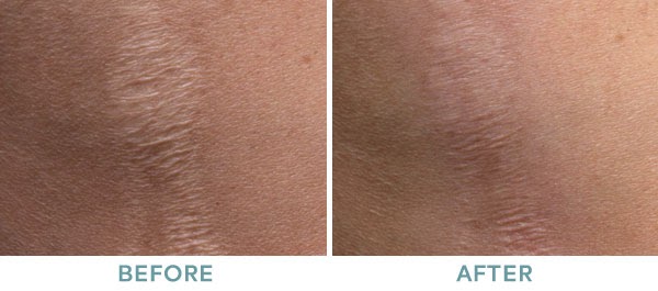 Scars | VitalSkin Dermatology