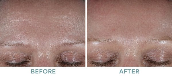 Skin Resurfacing + Micro-Needling - VitalSkin Dermatology