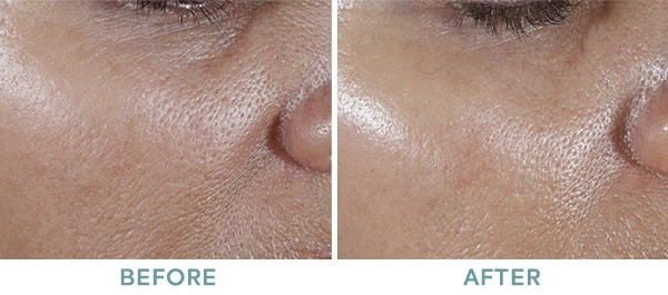 Skin Resurfacing + Micro-Needling - VitalSkin Dermatology