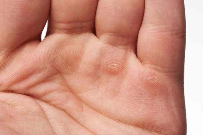 How to Deal With Calluses | VitalSkin Dermatology
