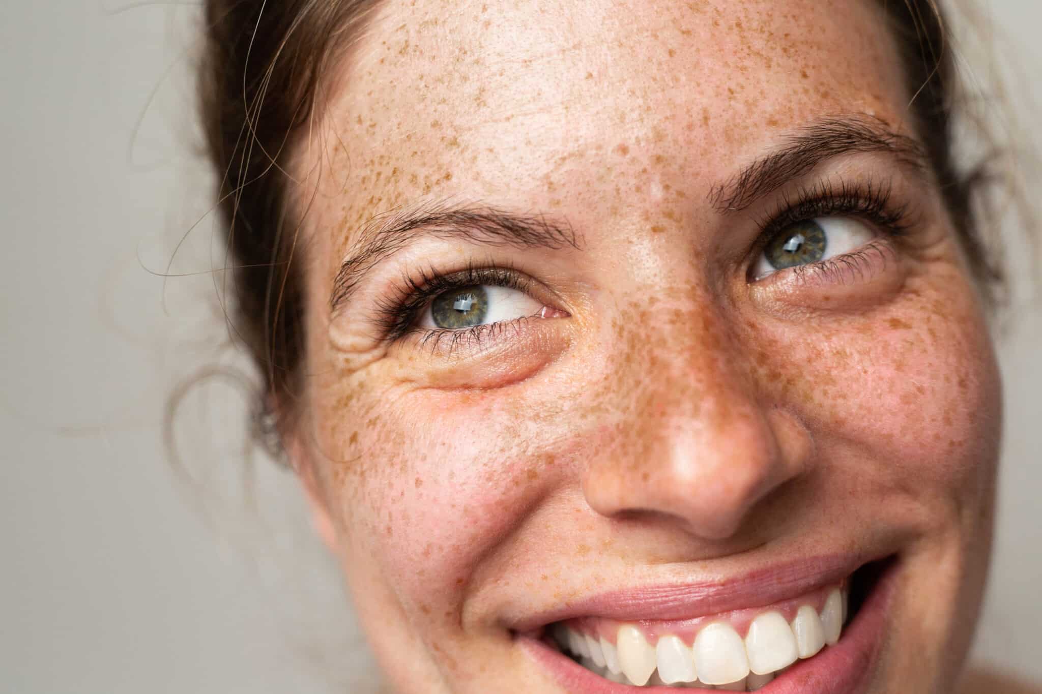 Freckles vs Moles: How to Spot the Difference | VitalSkin Dermatology